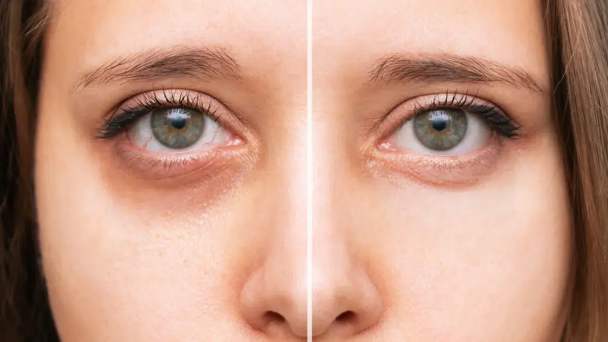 Discussing Red Under Eyes: What You Need to Know